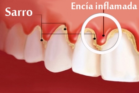 Causas y tratamiento de la gingivitis - Clínica Dental en Toledo