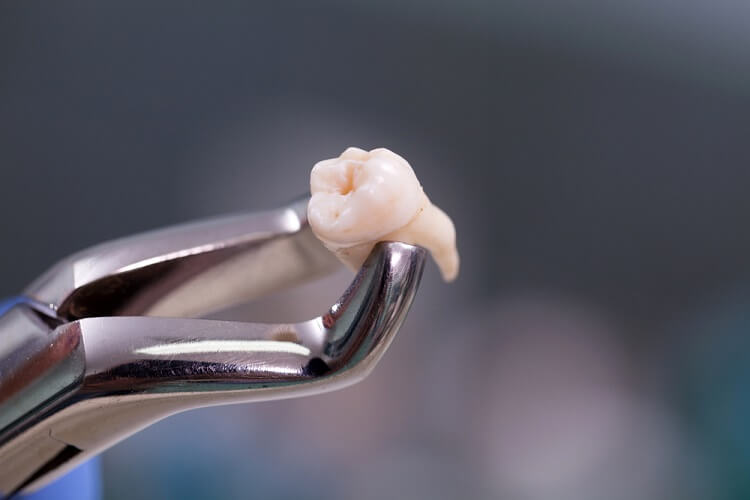 Todo sobre la extracción dental - Clínica Dental en Toledo