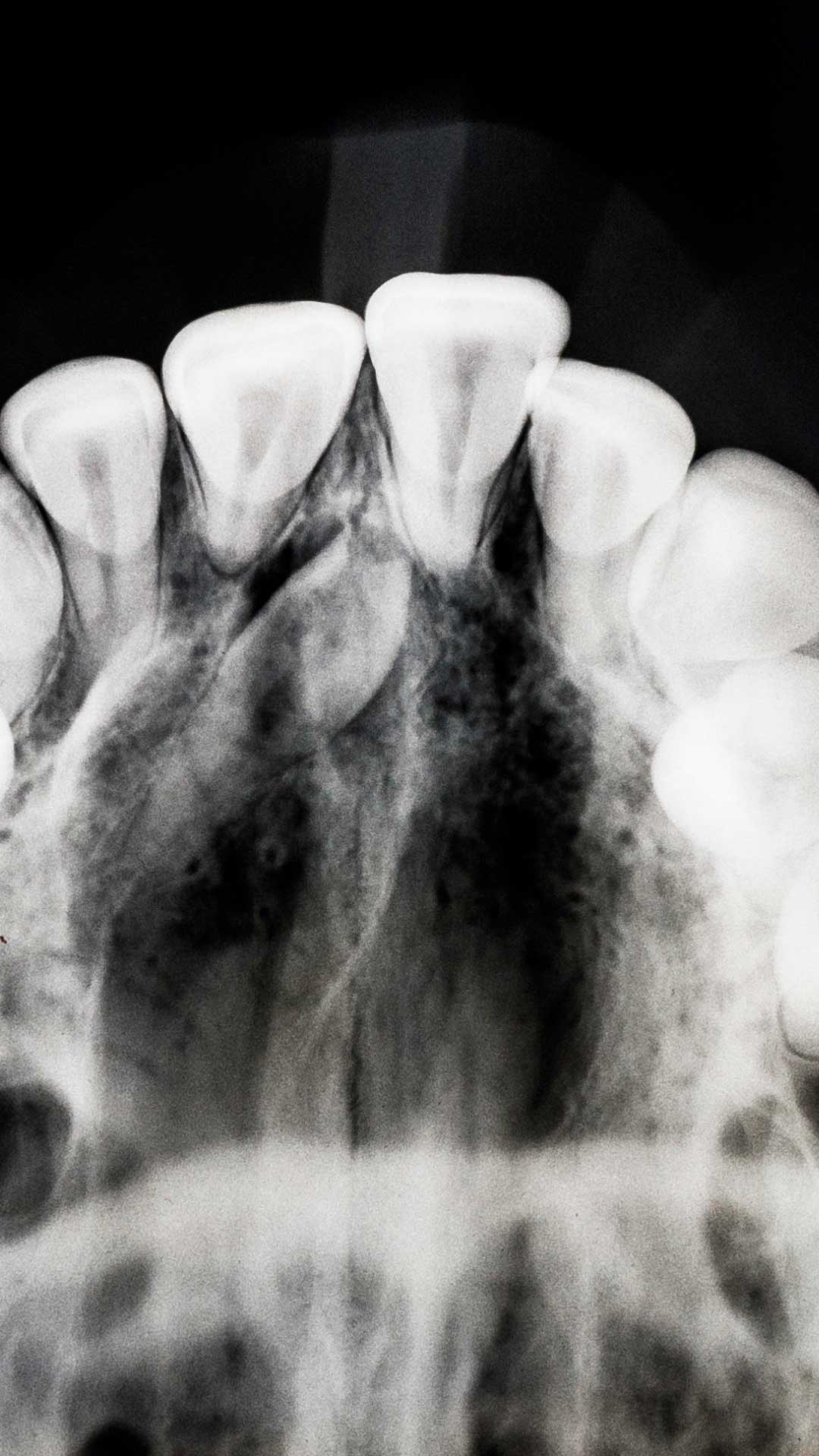 Hiperdoncia: Cuando aparecen más dientes de los necesarios - Clínica ...